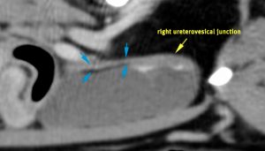Hydroureter and hydronephrosis in a dog - ProtonVet