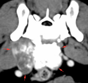 Sublumbar mass - ProtonVet