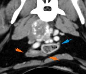 Sublumbar mass - ProtonVet