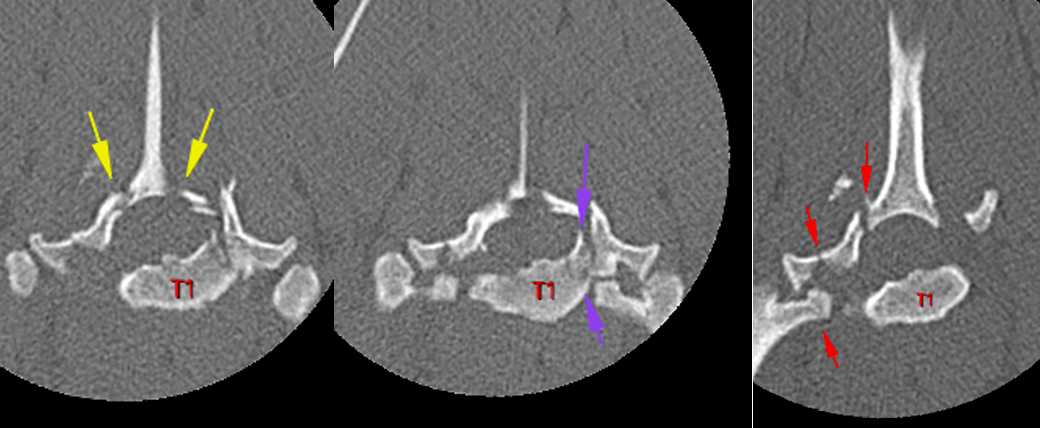 Multiple cervical and thoracic vertebral fractures in a dog - ProtonVet